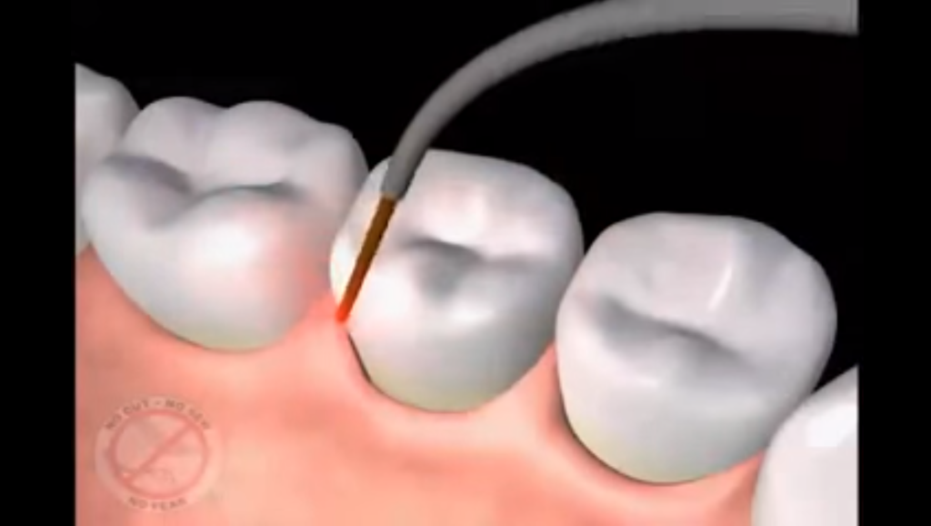 Gum Disease Treatment - Westerly, RI - Periodontist