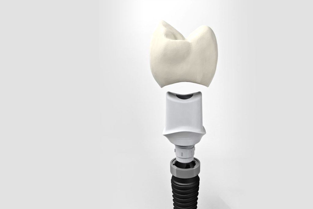 Dental Implants - Westerly, RI - New London, CT - Periodontist