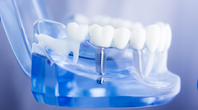 Revolutionize Your Smile: A Journey Through Whole Set of Teeth Implants ...